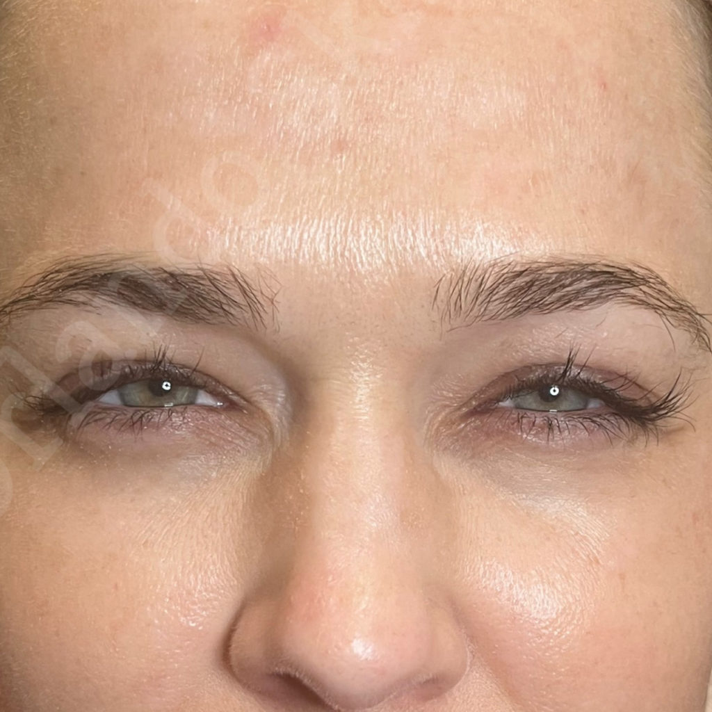 BOTOX® Winter Park | BOTOX® Injections