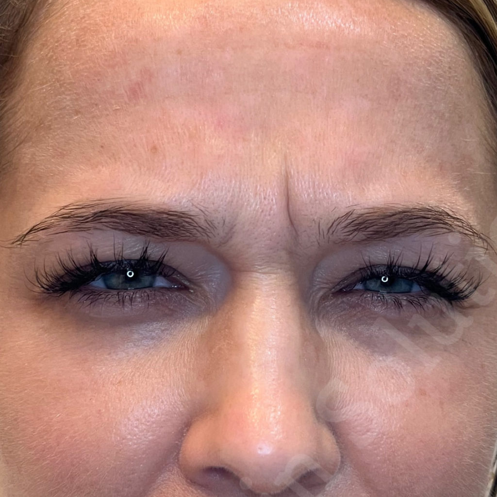 BOTOX® Winter Park | BOTOX® Injections